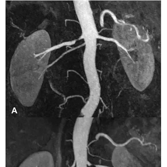MRI Scan For MR Angiography of Renal Vessels | Medifyhome
