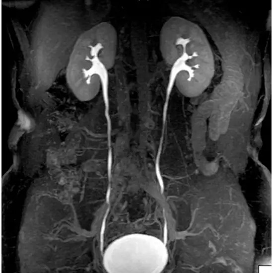 MRI Scan For KUB With Contrast | Medifyhome