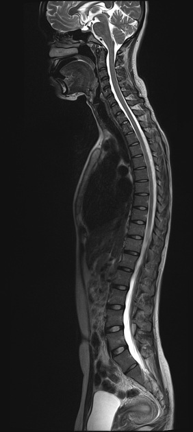 MRI Whole Spine | At affordable price | Medifyhome