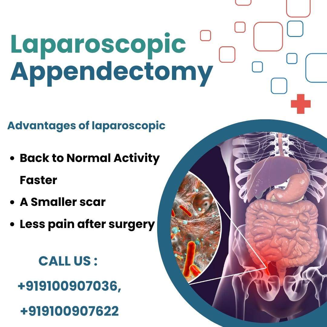 Laparoscopic Appendectomy Medifyhome Laparoscopic Appendectomy Medifyhome