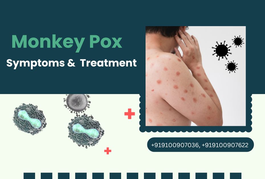 Monkeypox: Symptoms, Diagnosis, Treatment & Causes – Archyde