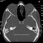 CECT Head and PNS Axial | Medifyhome