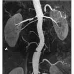 MRI Scan For MR Angiography of Renal Artery | Medifyhome