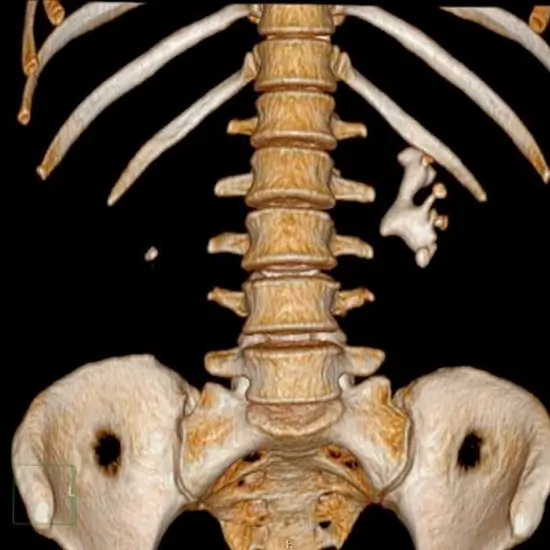 3D CT KUB scan | Medifyhome