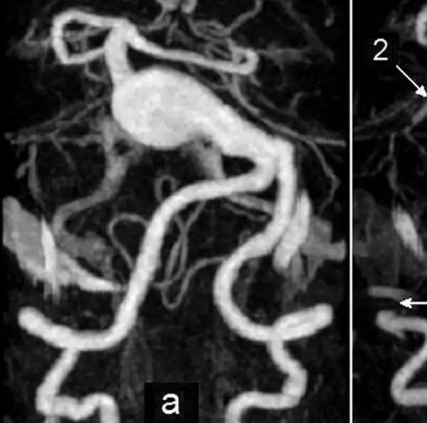 MRI Scan For CE MR Angiography Circle of Willis | Medifyhome