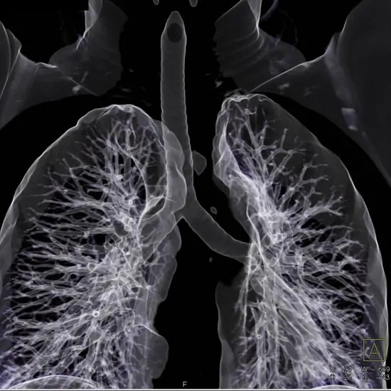 CECT Chest With Virtual Bronchoscopy | Medifyhome