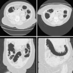 CT Colonography | Medifyhome