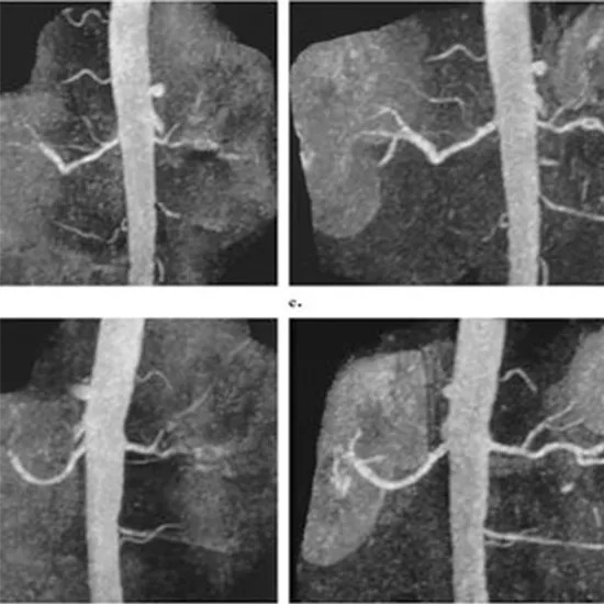MR Angiography Aorta with Contrast | Quick Results | Medifyhome