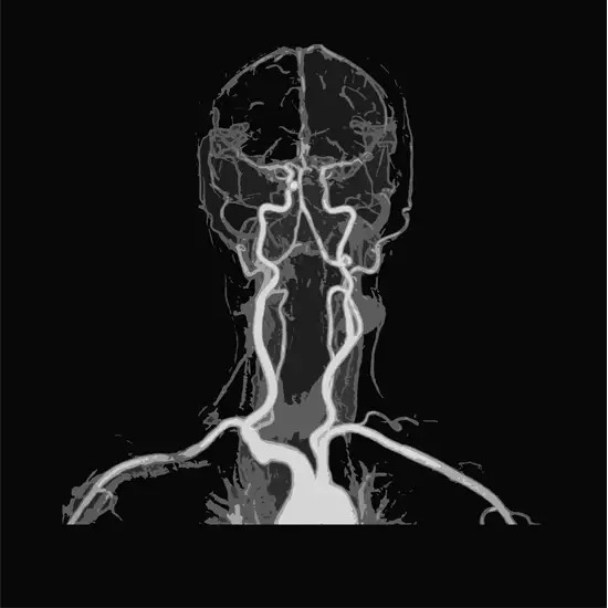 MRI Scan For MR Angiography Neck Vessels | Medifyhome