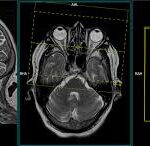 MRI Scan For Cisternography Head | Medifyhome