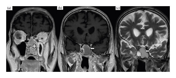 MRI Facial Bones | At affordable Prices | Medifyhome