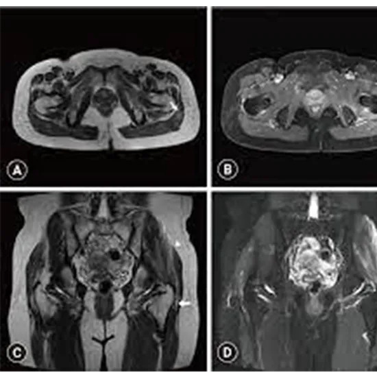 MRI Gluteal Region