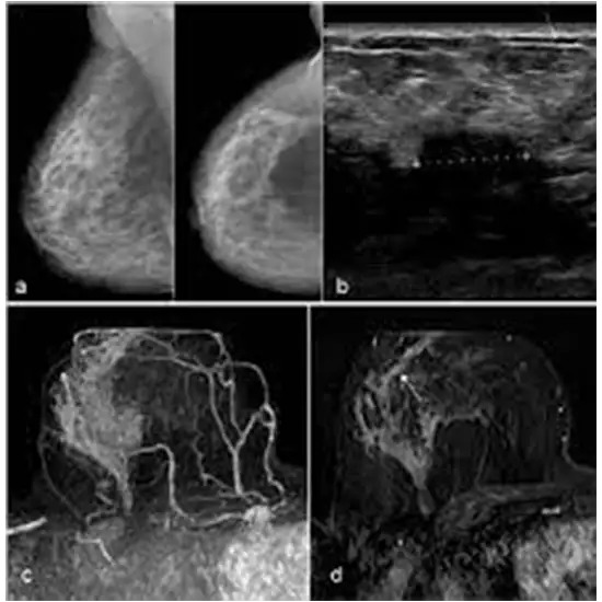 MRI Scan For Left Breast With Contrast | Medifyhome