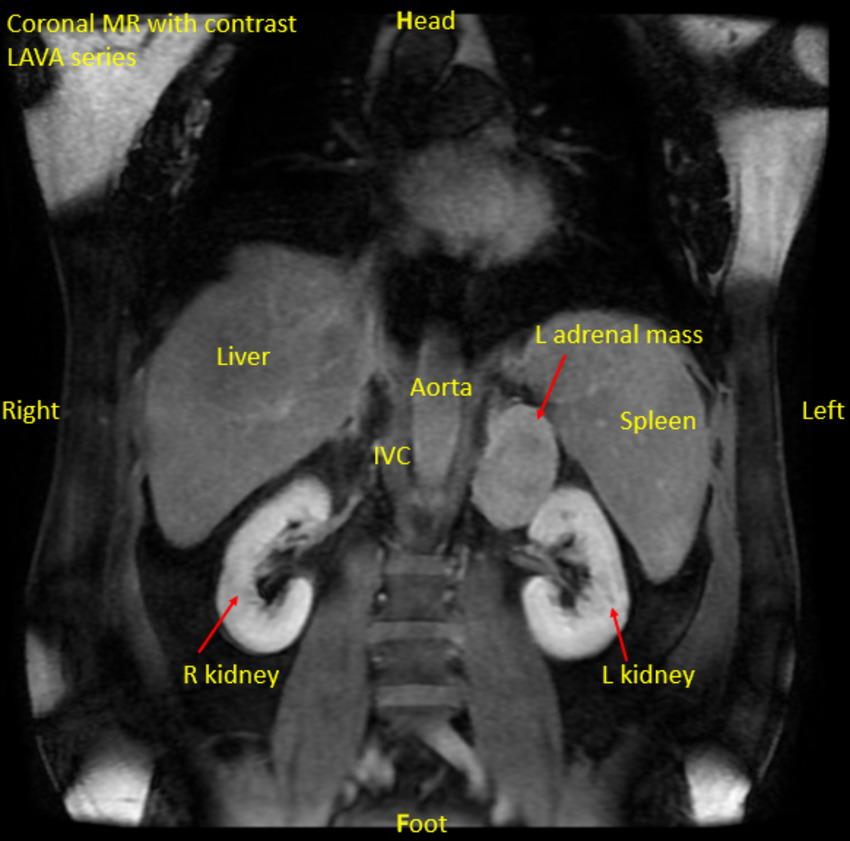 MRI Lower Abdomen With Contrast | Starting at ₹6000 | Medifyhome