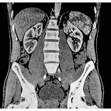 MRI Lower Abdomen | Starting at ₹4500 | Medifyhome