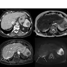 MRI Multiphasic Upper Abdomen | Starting at ₹8000 | Medifyhome
