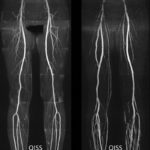 MRI For Peripheral Angiography | Medifyhome