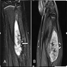 MRI For Right Forearm | Medifyhome