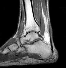 MRI Screening Left Ankle | At affordable cost | Medifyhome