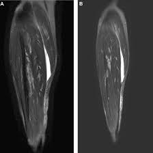 MRI Screening of the Calf | Starts at ₹3000 | Medifyhome