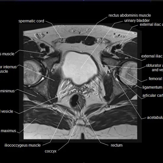 MRI of the Upper Pelvis Region | Medifyhome