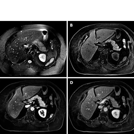 MRI Whole Abdomen Pancreas | Medifyhome