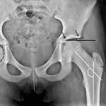 CT Hip Joint with Thigh Scan | Medifyhome