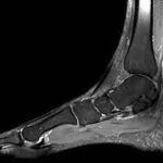 MRI toe | Medifyhome