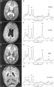 MRI Scan Brain With MRS | Medifyhome