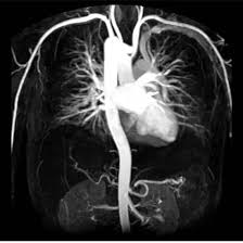 MR Angiography Chest | Medifyhome