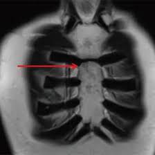 MRI Screening Of Sternum | Medifyhome