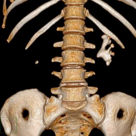 3D CT Dorsal Spine | Medintu