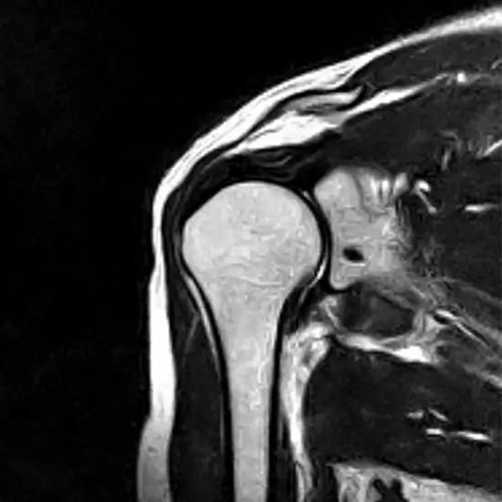 MRI Screening of Shoulder | Medifyhome