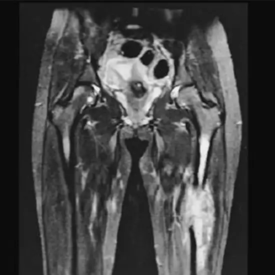 MRI Screening of Left Hip Joint | Medifyhome