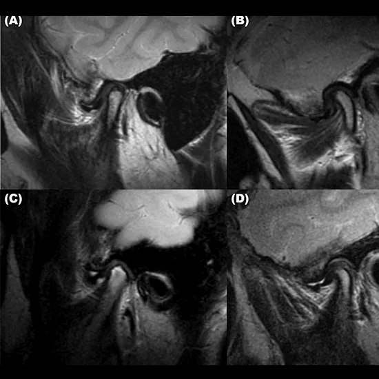MRI Scan For Left TM Joint | Medifyhome