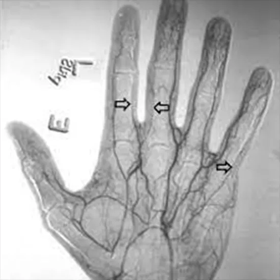 CT Hand Angiography | Medifyhome