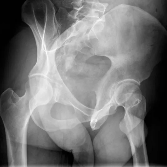 X-Ray Both Hip Oblique View | Medifyhome