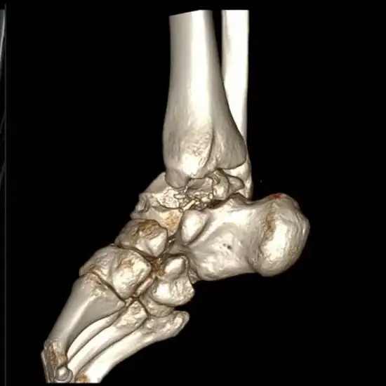 3D CT Ankle | Medifyhome