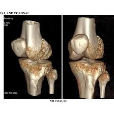 3D CT Knee Joint | Medifyhome