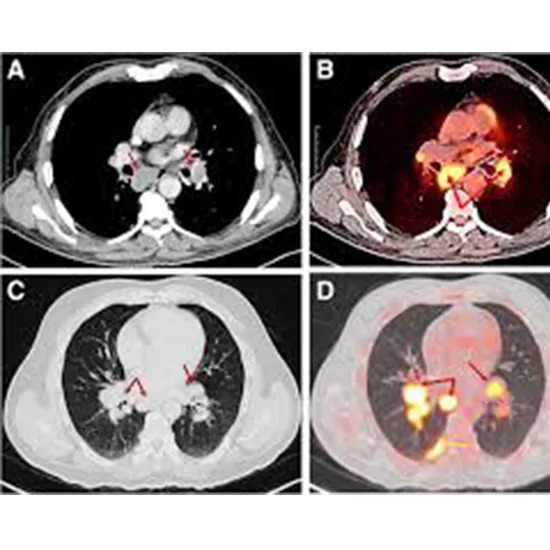 CECT Chest Scan | Medifyhome