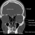 CECT Head with PNS | Medifyhome
