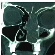 CECT PNS Coronal | Medifyhome