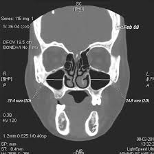 CECT Scan Maxilla | Medifyhome