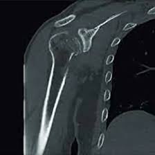 CECT Shoulder | Medifyhome