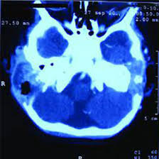 CECT Temporal Bone Axial and Coronal | Medifyhome