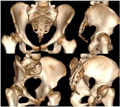 CT 3D Reconstruction Right Hip Joint | Medifyhome
