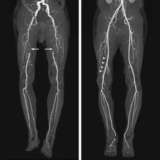 CT Angiography Left Lower Limb | Medifyhome