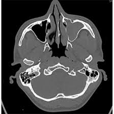 CT Head and PNS Coronal | Medifyhome