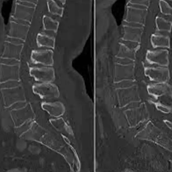 CT scan Single Vertebrae | Medifyhome