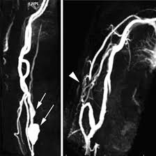MRI Scan For MR Angiography Left Forearm | Medifyhome
